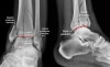 발목 골절fracture Of Ankle 발목이 비틀리면서 발목 뼈가 부러졌어요 네이버 블로그